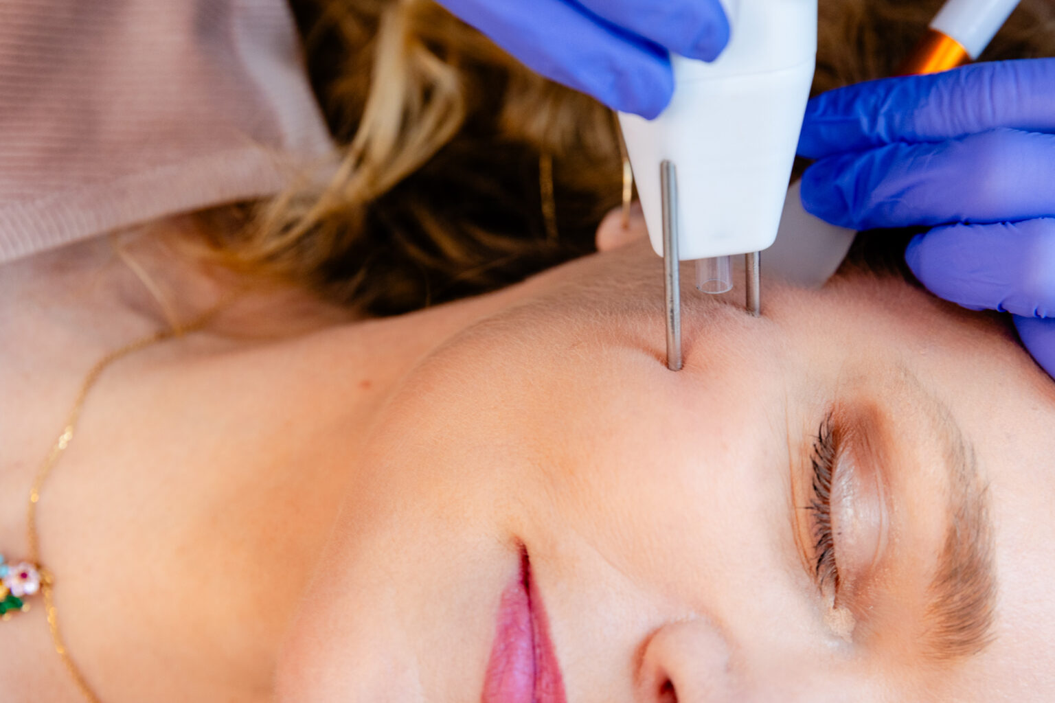 Plasma Facial in Mt. Juliet | Allyn Aesthetics
